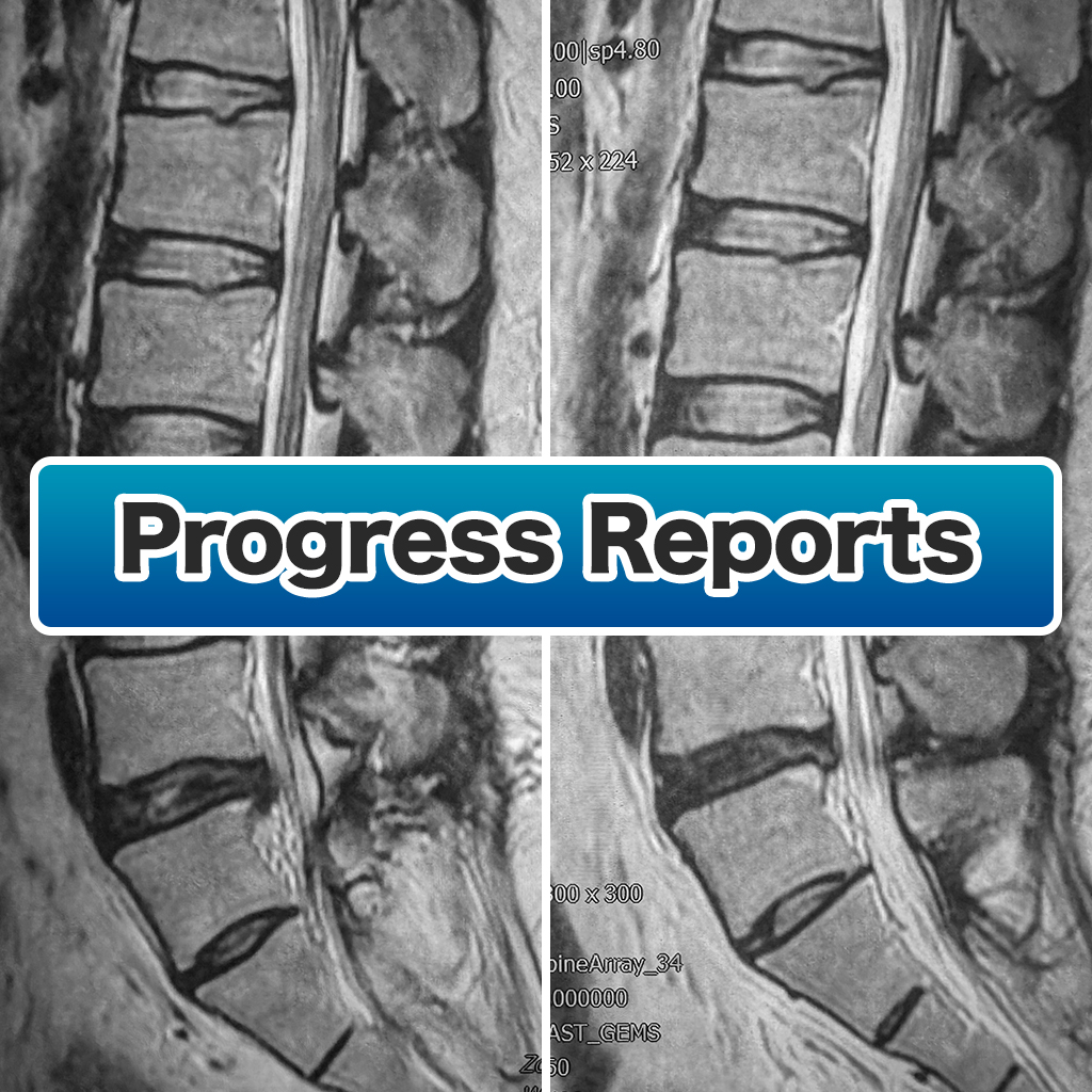 Seven Years After the Discseel Procedure - NLC Nonaka Lumbago Clinic