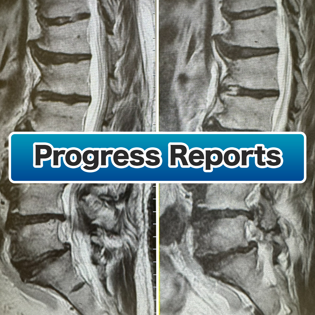 Efficacy of Stem Cell Culture Therapy for Lower Limb Numbness - NLC ...